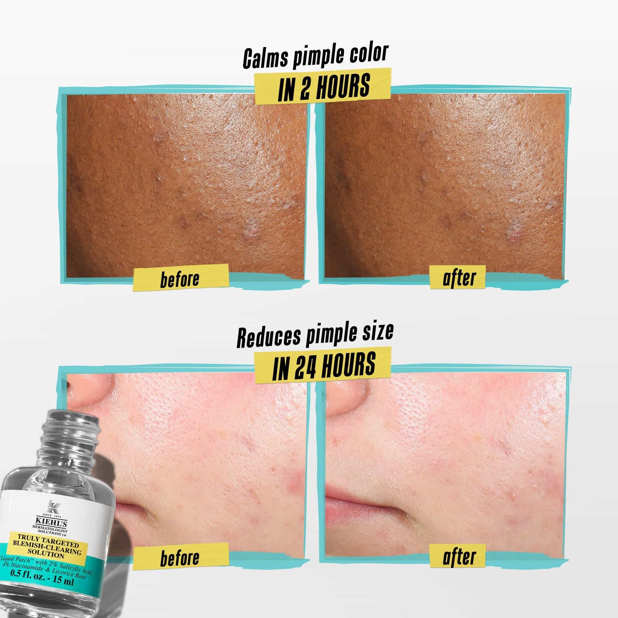 TRULY TARGETED BLEMISH-CLEARING SOLUTION 15 — Kiehl’s — Plasture lichid ...